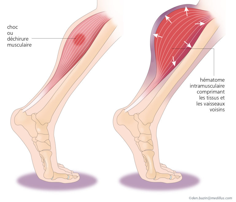 L'hémophilie - MHEMO MHEMO